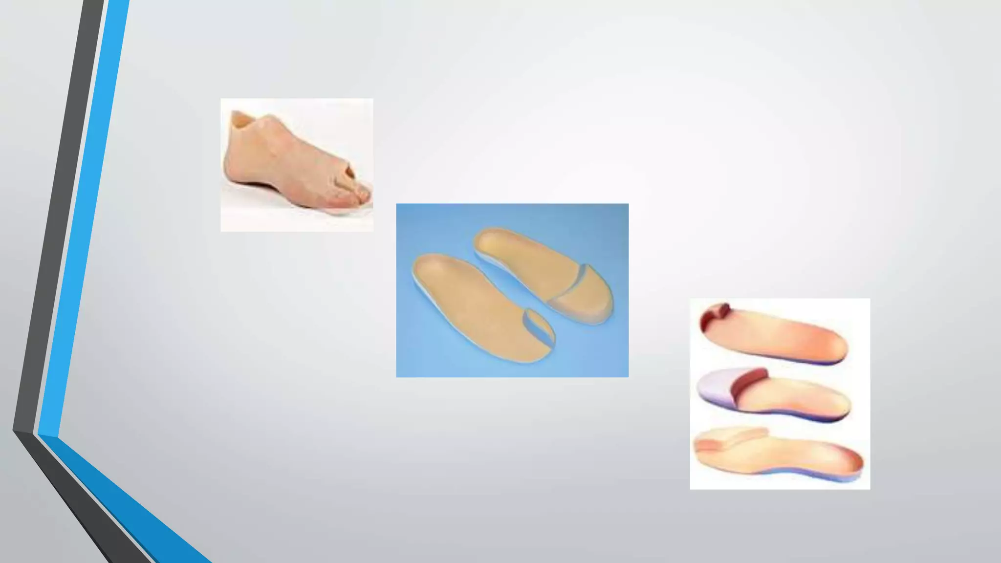 Prosthetic Management of Different Types of Partial Foot Amputation | PPTX