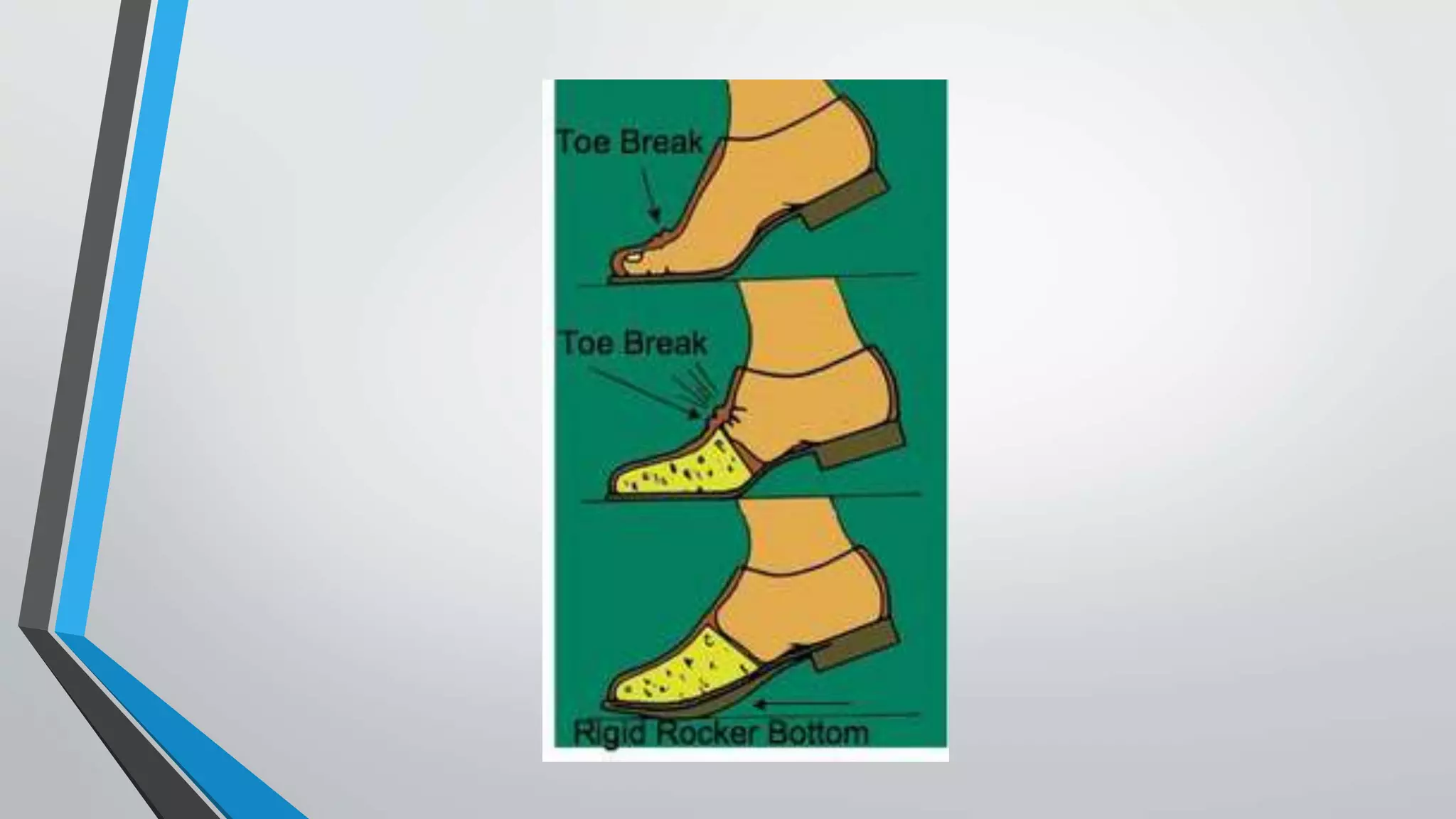 Prosthetic Management of Different Types of Partial Foot Amputation | PPTX