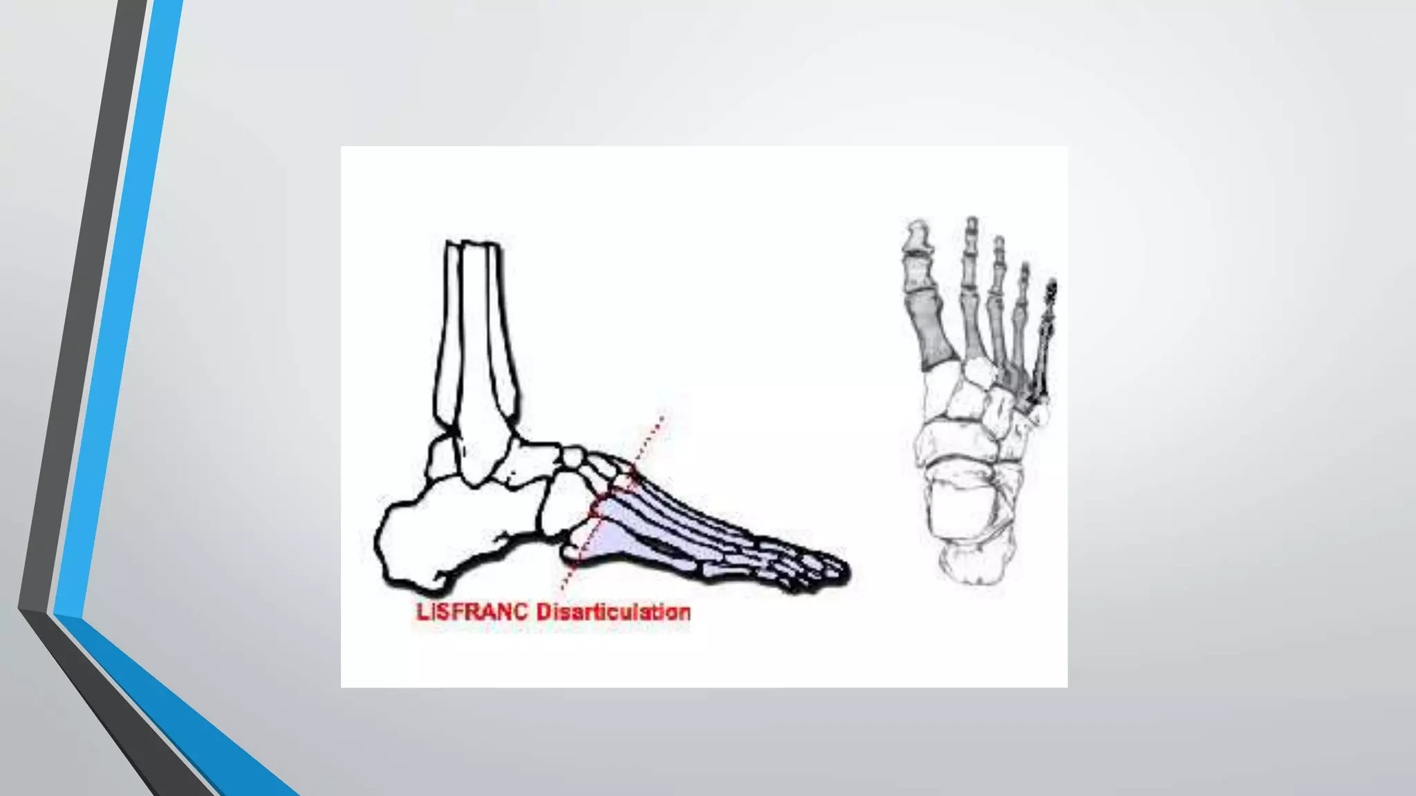 Prosthetic Management of Different Types of Partial Foot Amputation | PPTX
