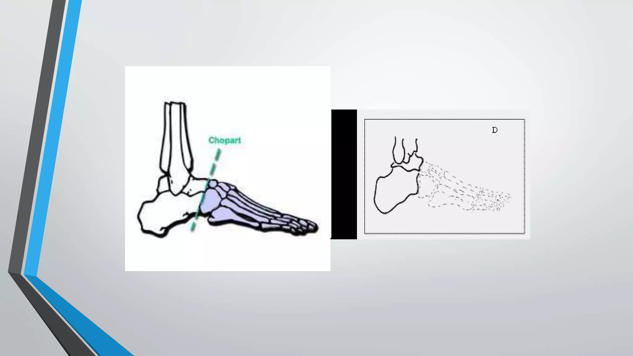 Prosthetic Management of Different Types of Partial Foot Amputation | PPTX
