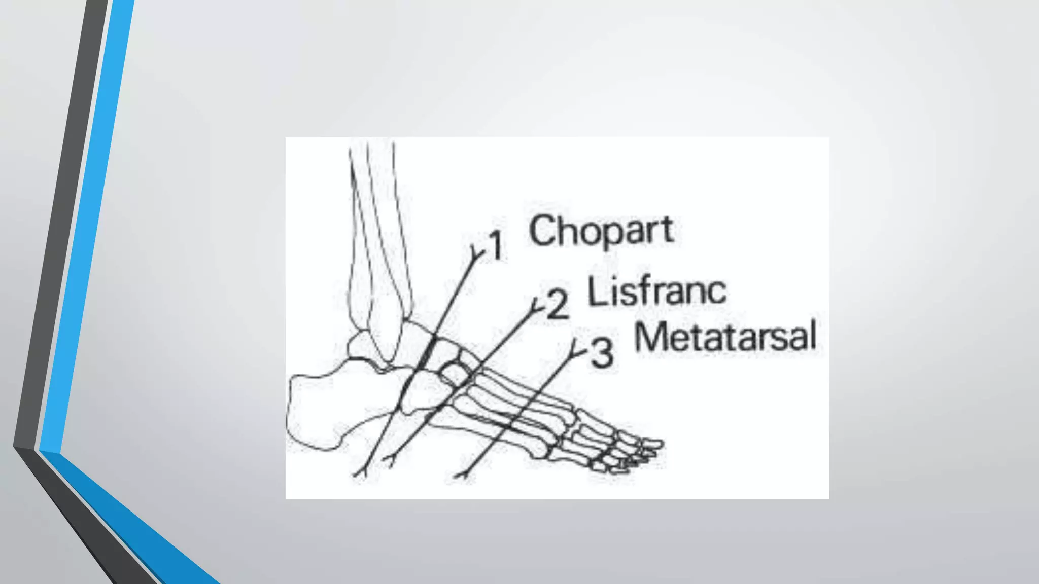 Prosthetic Management of Different Types of Partial Foot Amputation | PPTX
