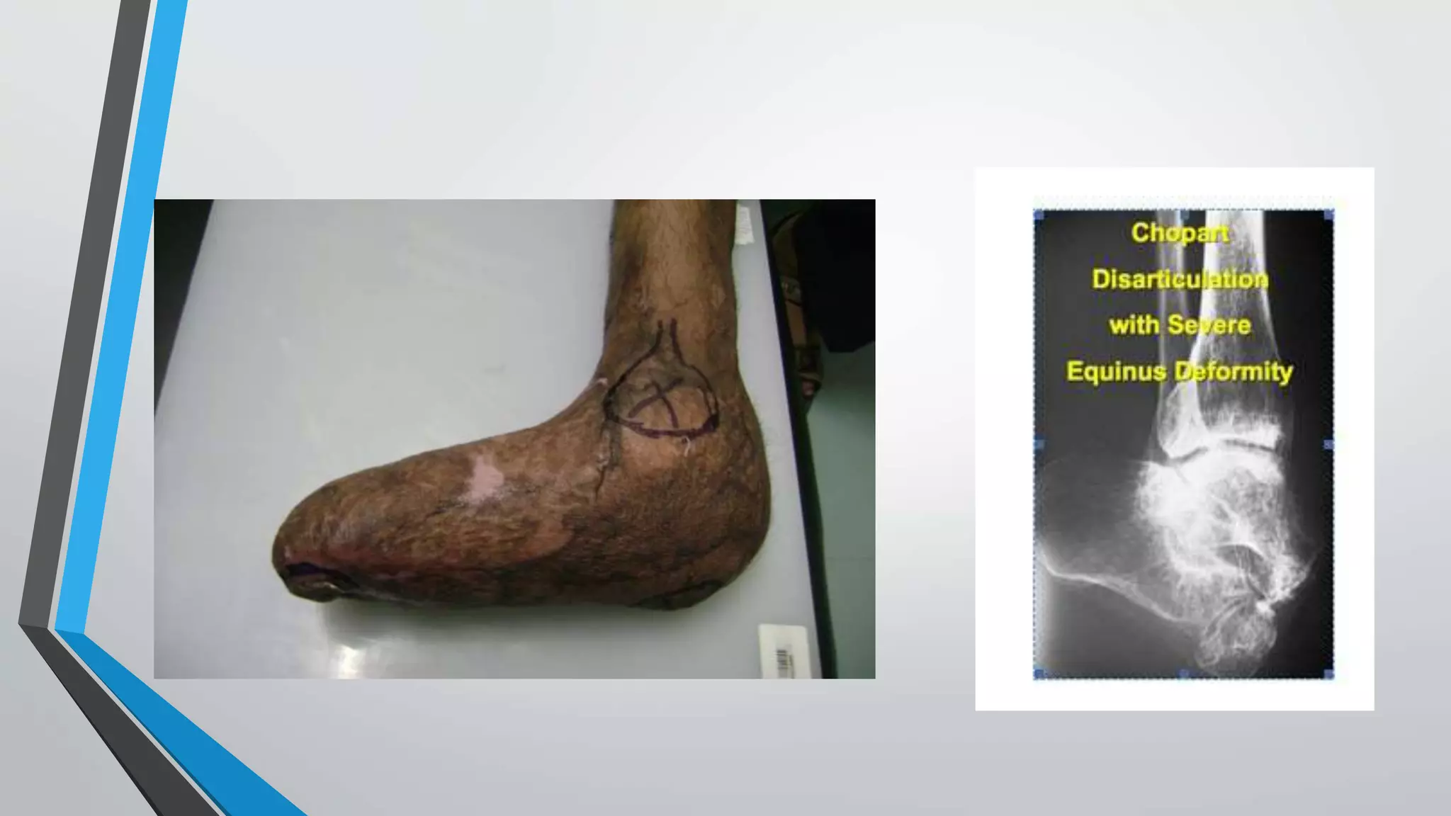 Prosthetic Management of Different Types of Partial Foot Amputation | PPTX