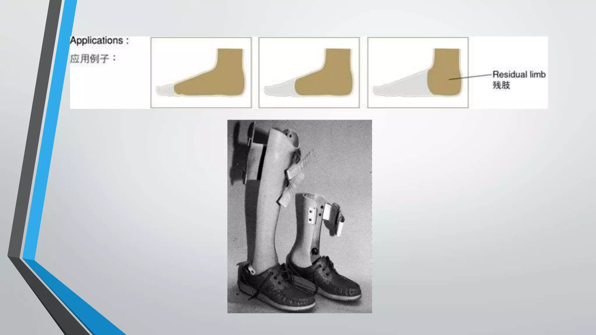 Prosthetic Management of Different Types of Partial Foot Amputation | PPTX