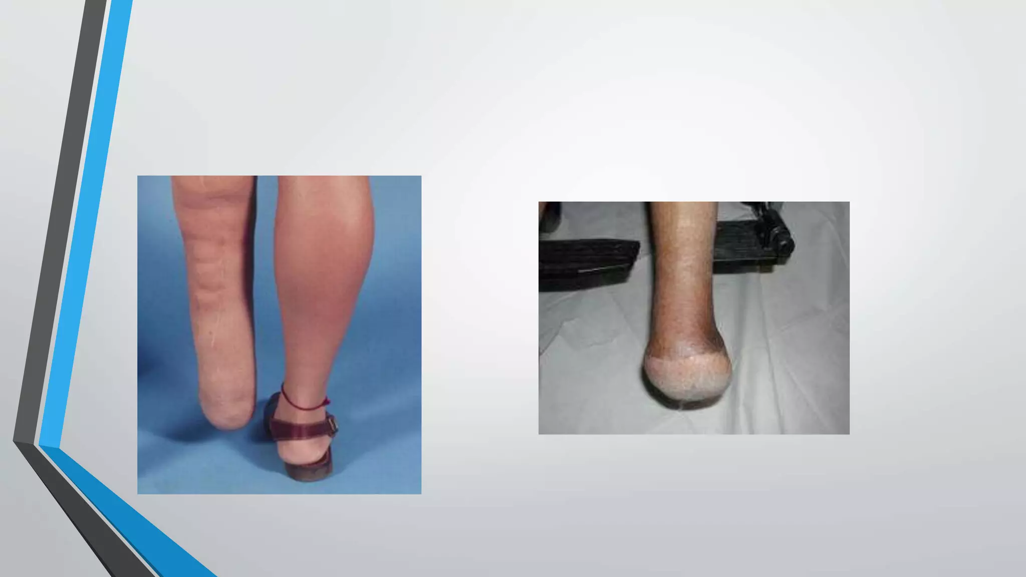 Prosthetic Management of Different Types of Partial Foot Amputation | PPTX