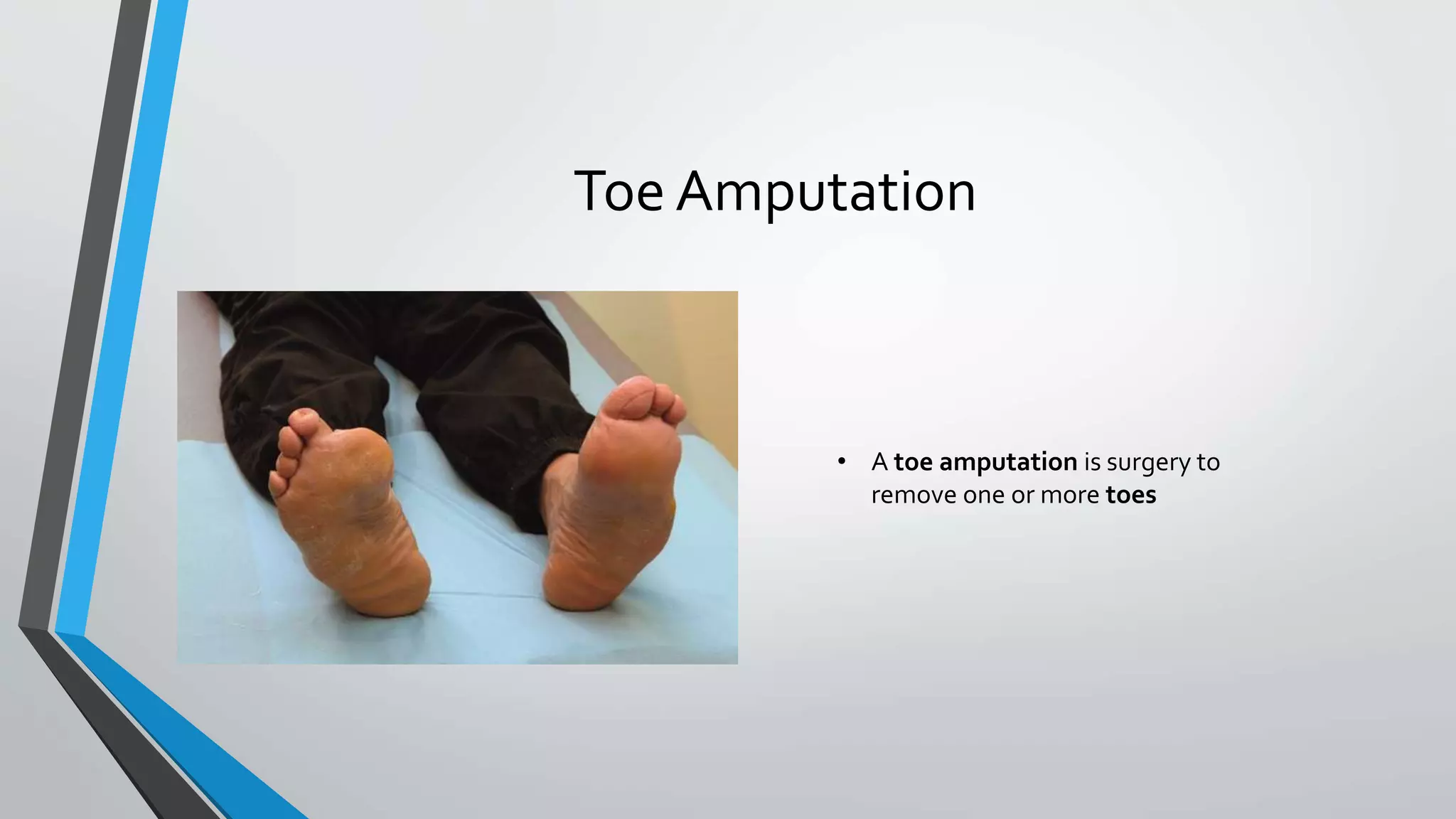 Prosthetic Management of Different Types of Partial Foot Amputation | PPTX