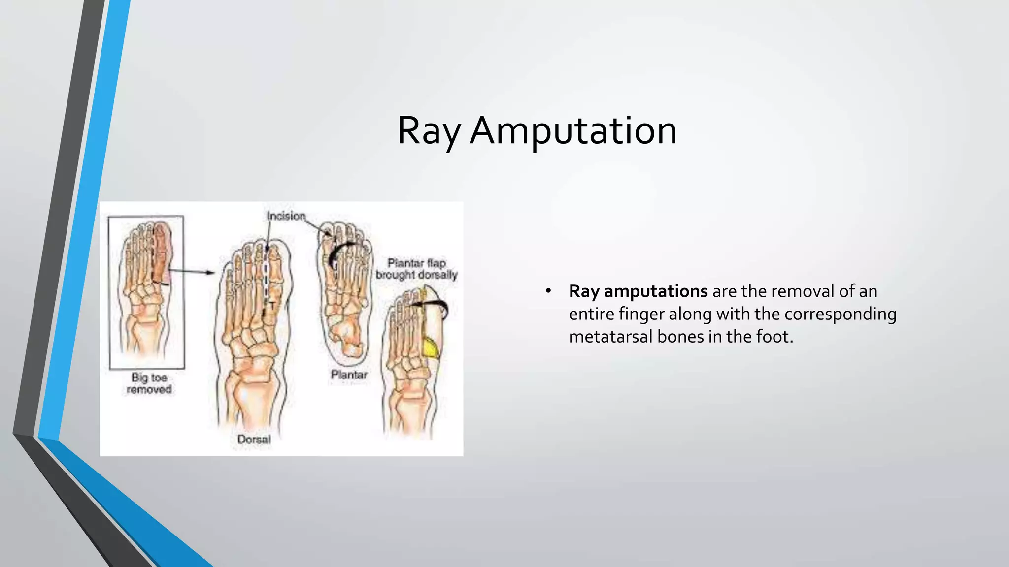 Prosthetic Management of Different Types of Partial Foot Amputation | PPTX