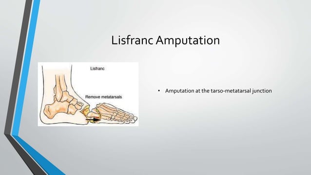 Prosthetic Management of Different Types of Partial Foot Amputation ...