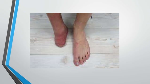 Prosthetic Management of Different Types of Partial Foot Amputation ...
