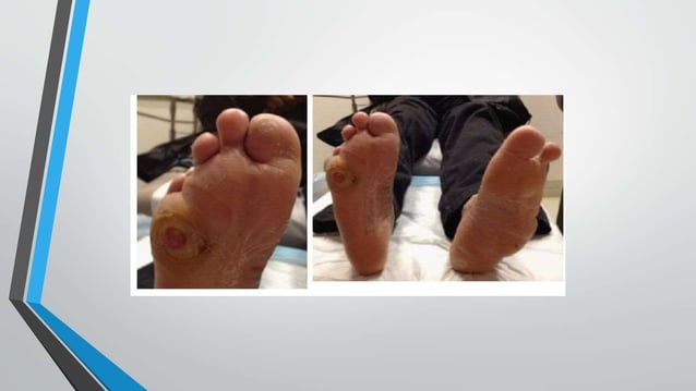 Prosthetic Management of Different Types of Partial Foot Amputation ...