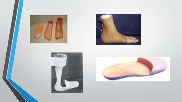 Prosthetic Management of Different Types of Partial Foot Amputation ...