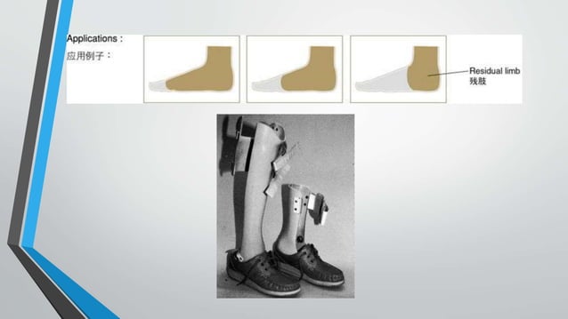 Prosthetic Management of Different Types of Partial Foot Amputation ...