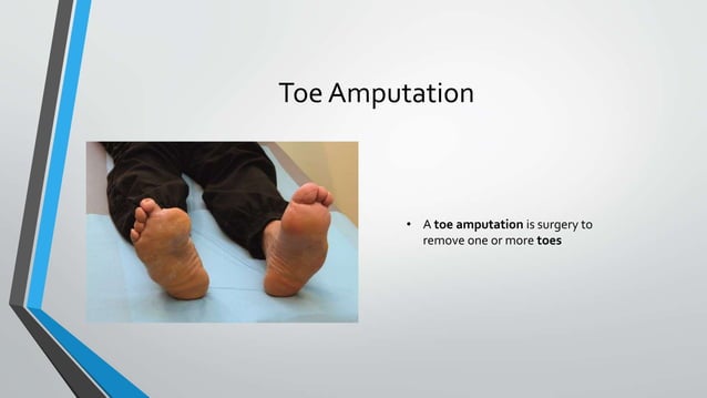 Prosthetic Management of Different Types of Partial Foot Amputation