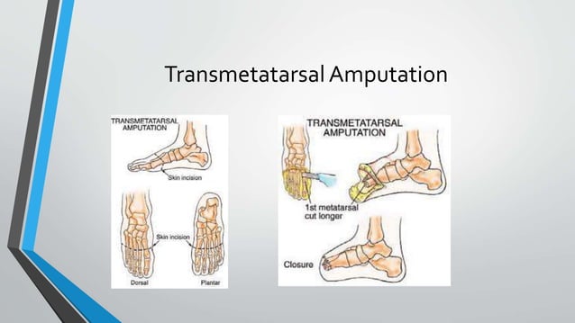 Prosthetic Management of Different Types of Partial Foot Amputation