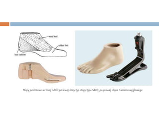 Partial foot prosthesis 1 | PPTX