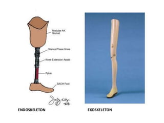 Partial foot prosthesis 1 | PPTX