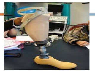 Partial foot prosthesis 1 | PPTX