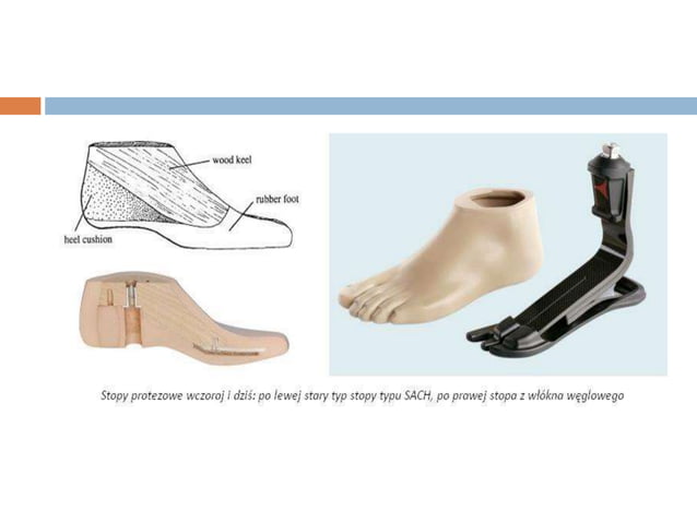 Partial foot prosthesis | PPTX