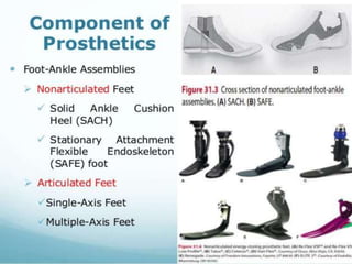 Partial foot prosthesis | PPTX