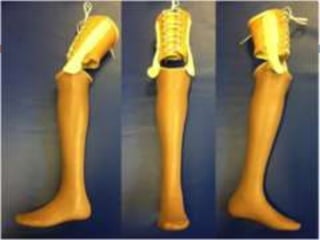 Partial foot prosthesis | PPTX