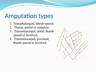 PROSTHETIC SCIENCE PARTIAL HAND & MANAGMENT.pptx