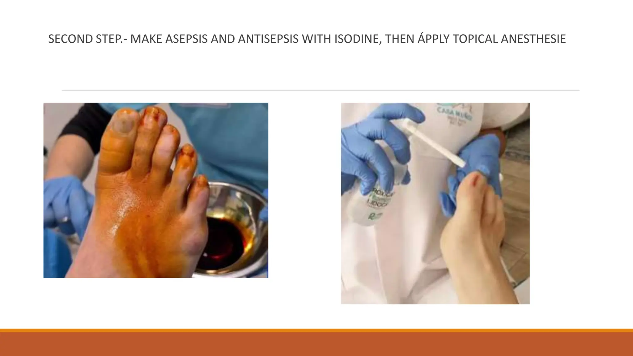 PARTIAL NAIL EXTRACTION PROCEDURE.pptx