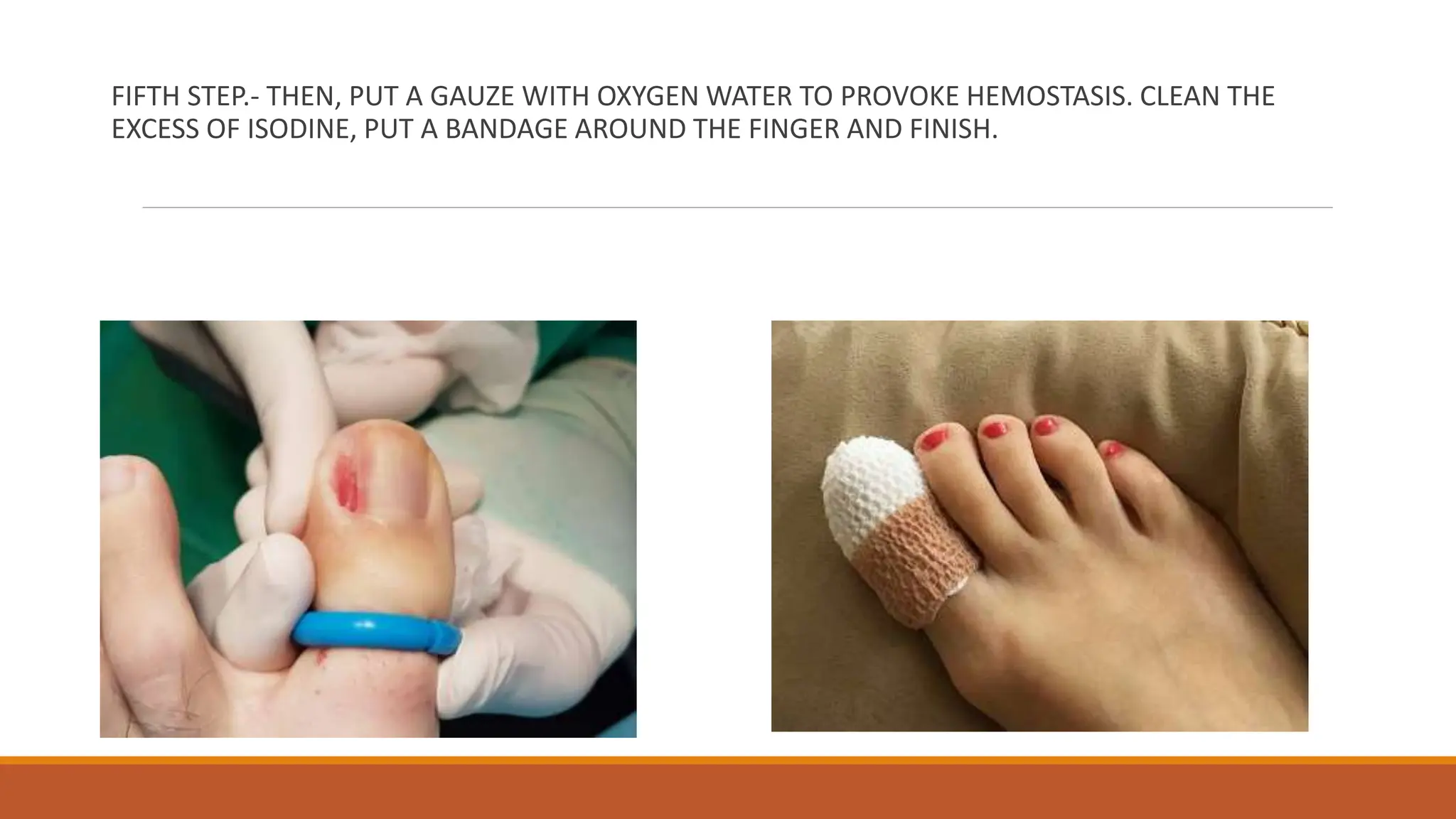 PARTIAL NAIL EXTRACTION PROCEDURE.pptx