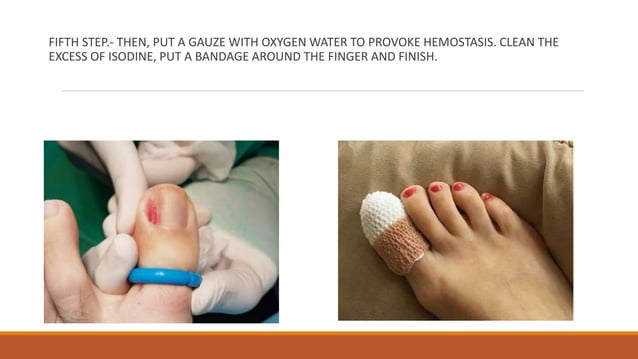 PARTIAL NAIL EXTRACTION PROCEDURE.pptx