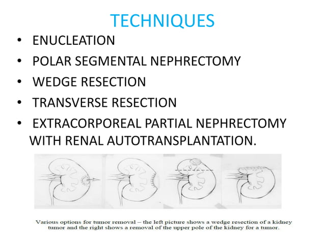 Partial nephrectomy | PPTX | Blood Disorders | Diseases and Conditions