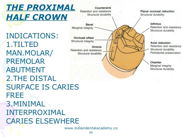 Partial veener crowns /certified fixed orthodontic courses by Indian