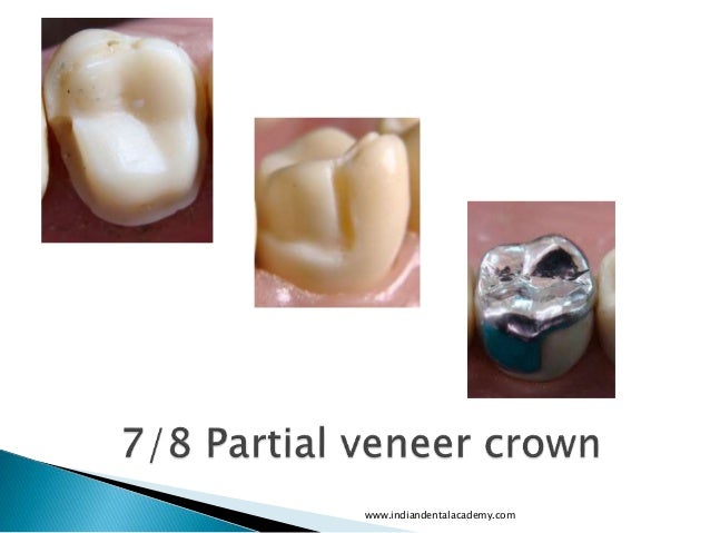 Partial veneer crown pics/ orthodontic straight wire technique
