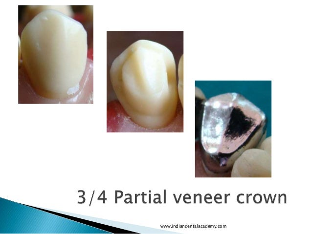 Partial veneer crown pics/ orthodontic straight wire technique