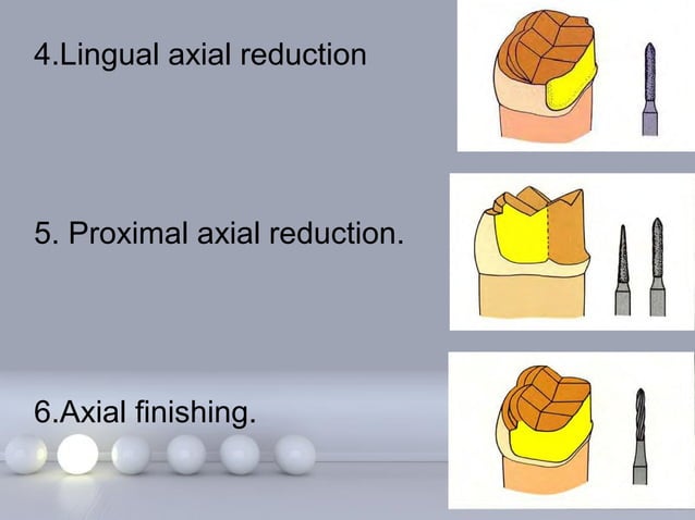 Dr Saransh Malot Partial veneer presentation preparation and ...