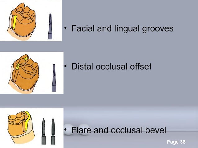 Dr Saransh Malot Partial veneer presentation preparation and ...