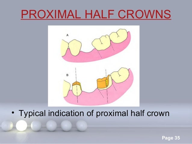 Dr Saransh Malot Partial veneer presentation preparation and classifi…