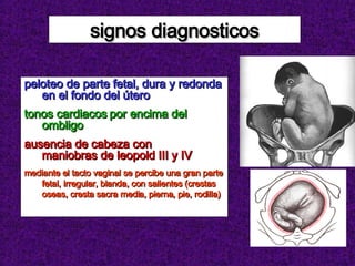 Parto Podalico | PPT