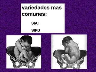 Parto Podalico | PPT