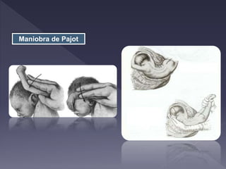 Mecanismo del parto podalico segun la presentación podalica | PPTX