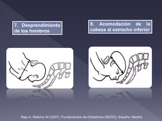 Mecanismo del parto podalico segun la presentación podalica | PPTX