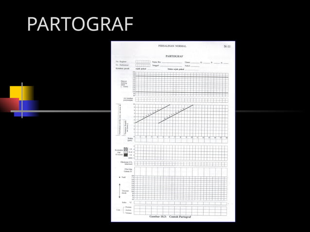 PARTOGRAF br new ya by klinik kita ya 2024 | PPT