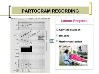 Partogram | PPT