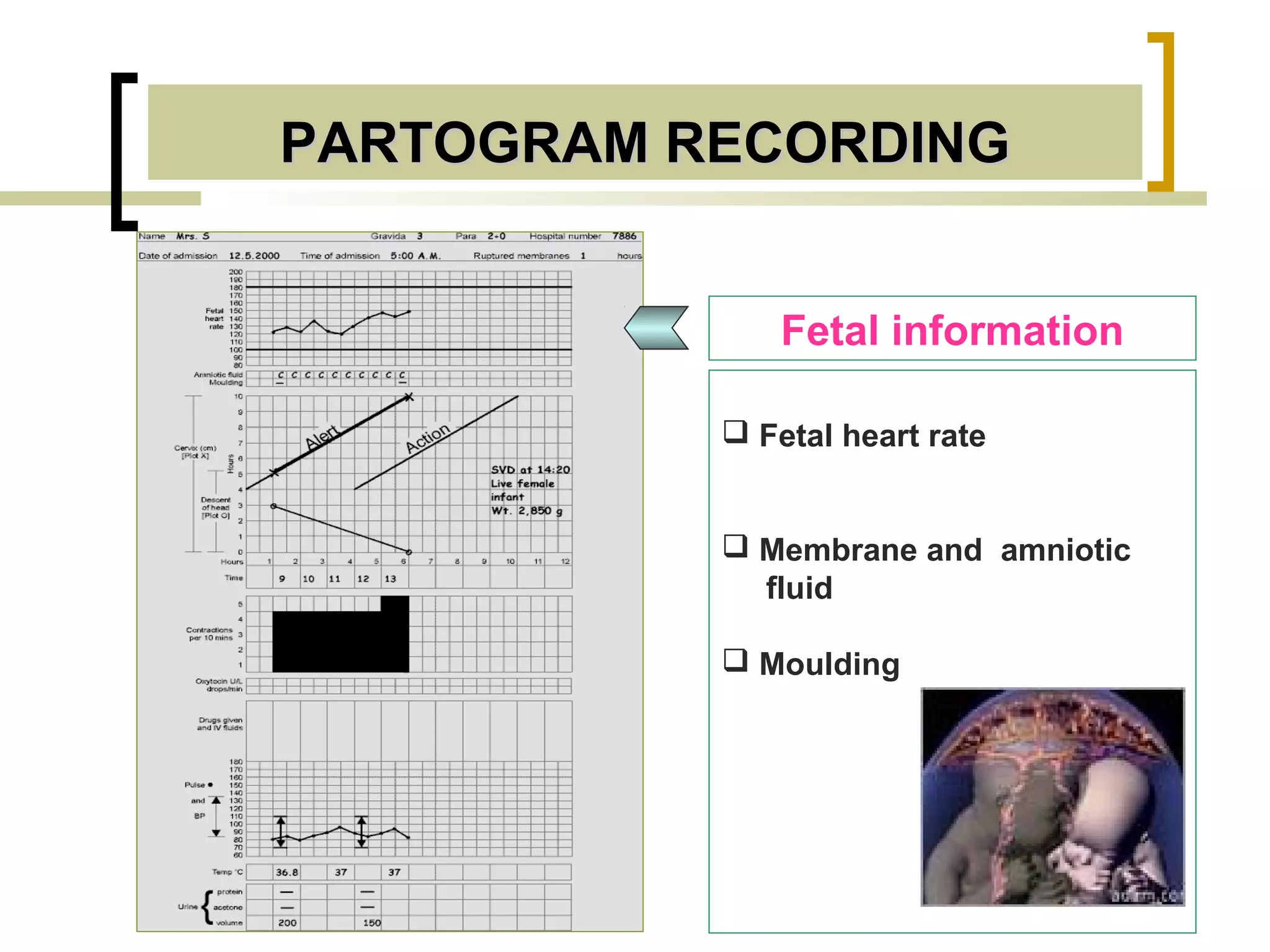 Partogram | PPT