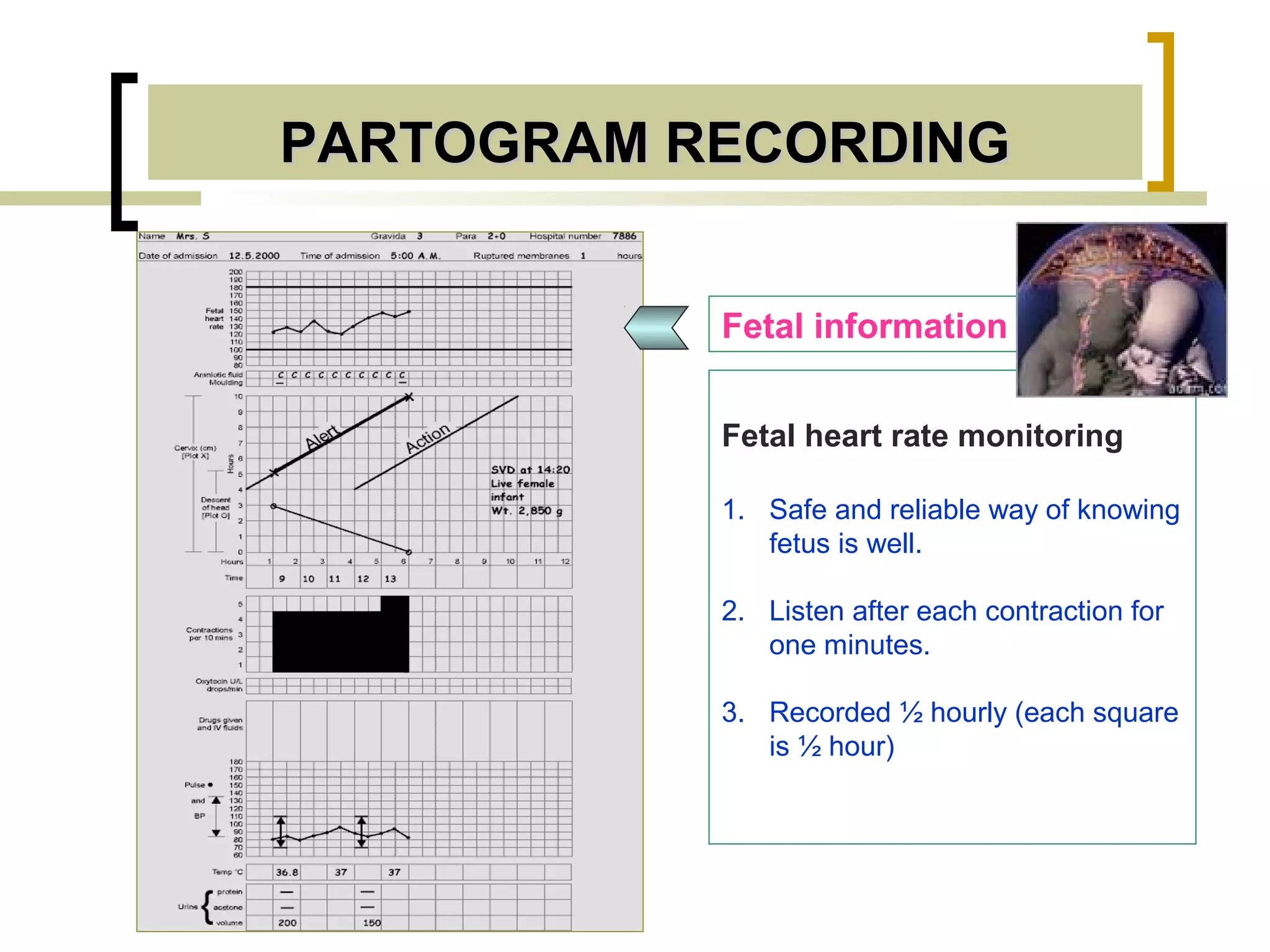Partogram | PPT