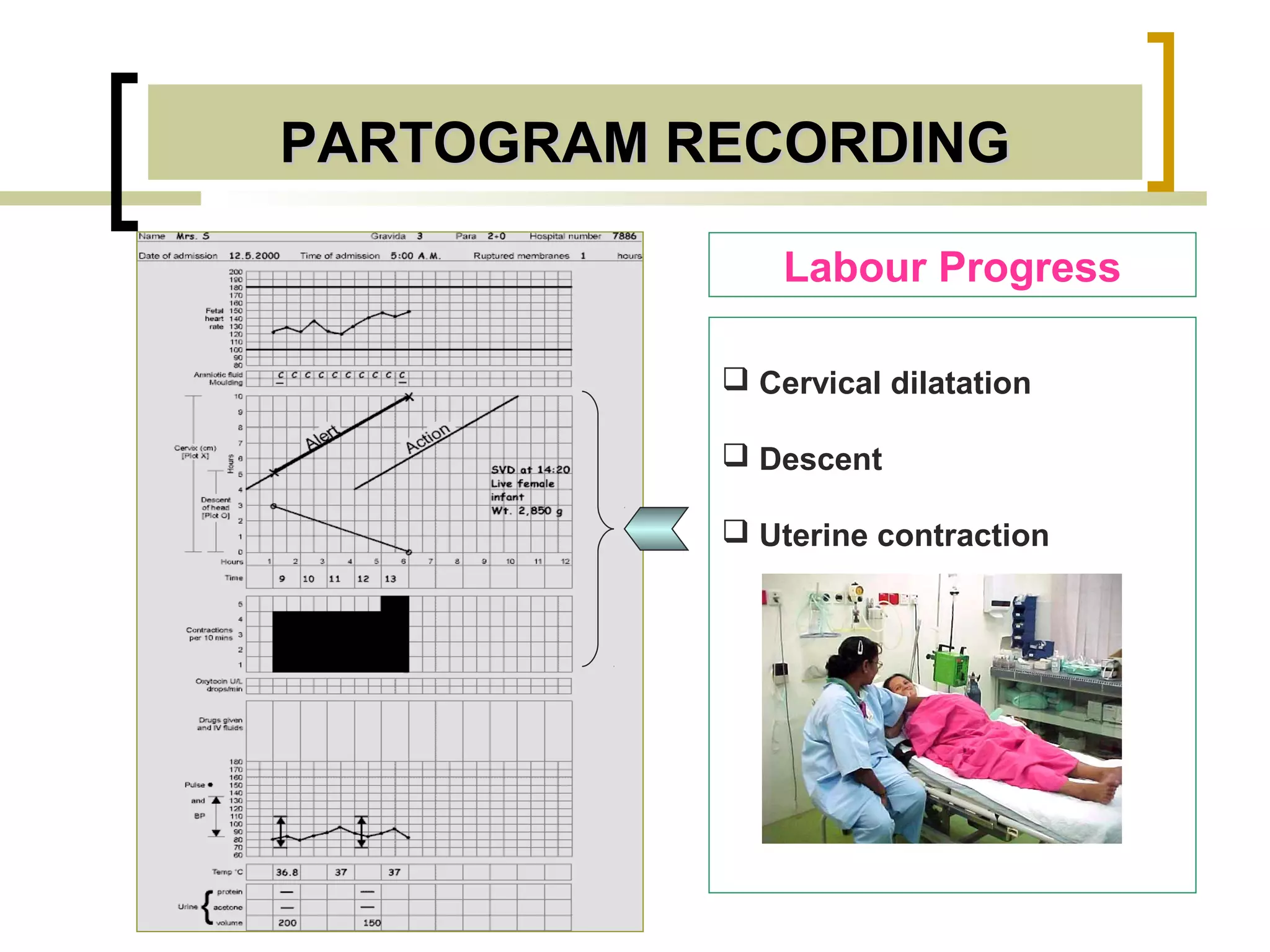 Partogram | PPT