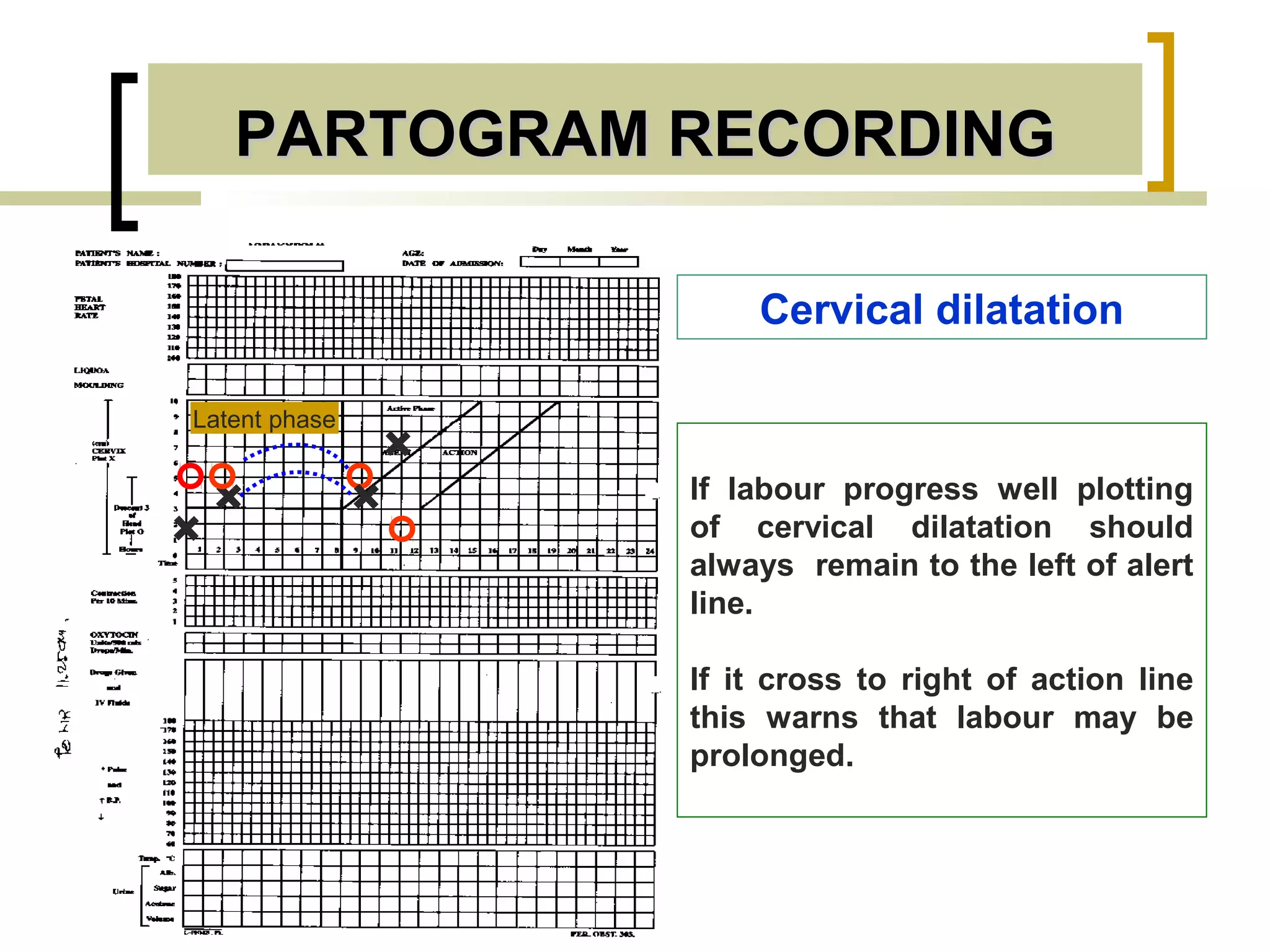 Partogram | PPT