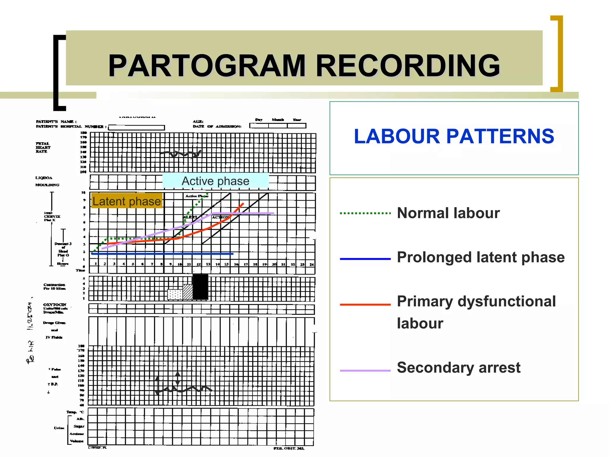 Partogram | PPT
