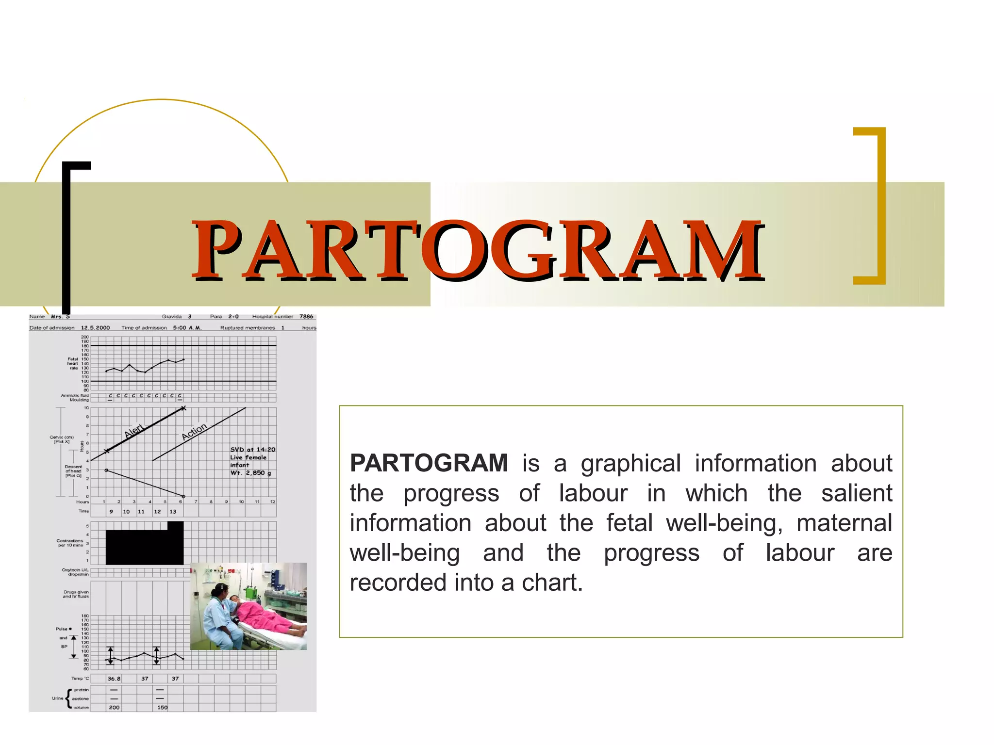 Partogram | PPT | Pregnancy | Reproductive Health