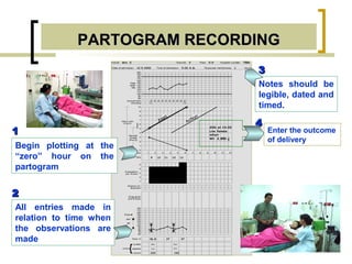 Partogram | PPT
