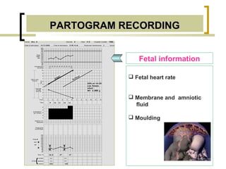 Partogram | PPT