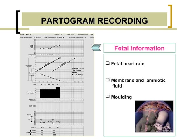 Partogram | PPT | Pregnancy | Reproductive Health