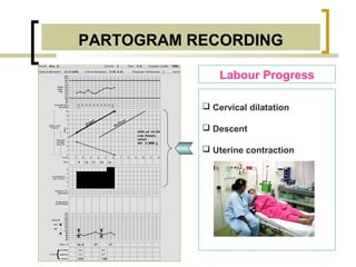 Partogram | PPT